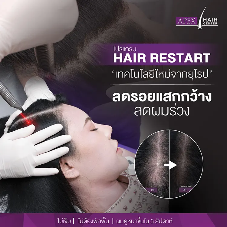 เลเซอร์รักษาผมร่วง Hair Restart คืออะไร
